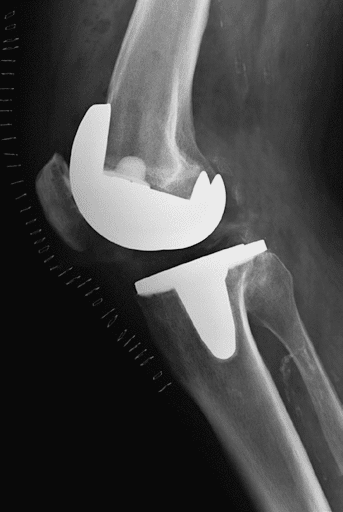 Why Medial Pivot? - Medial Pivot Knee
